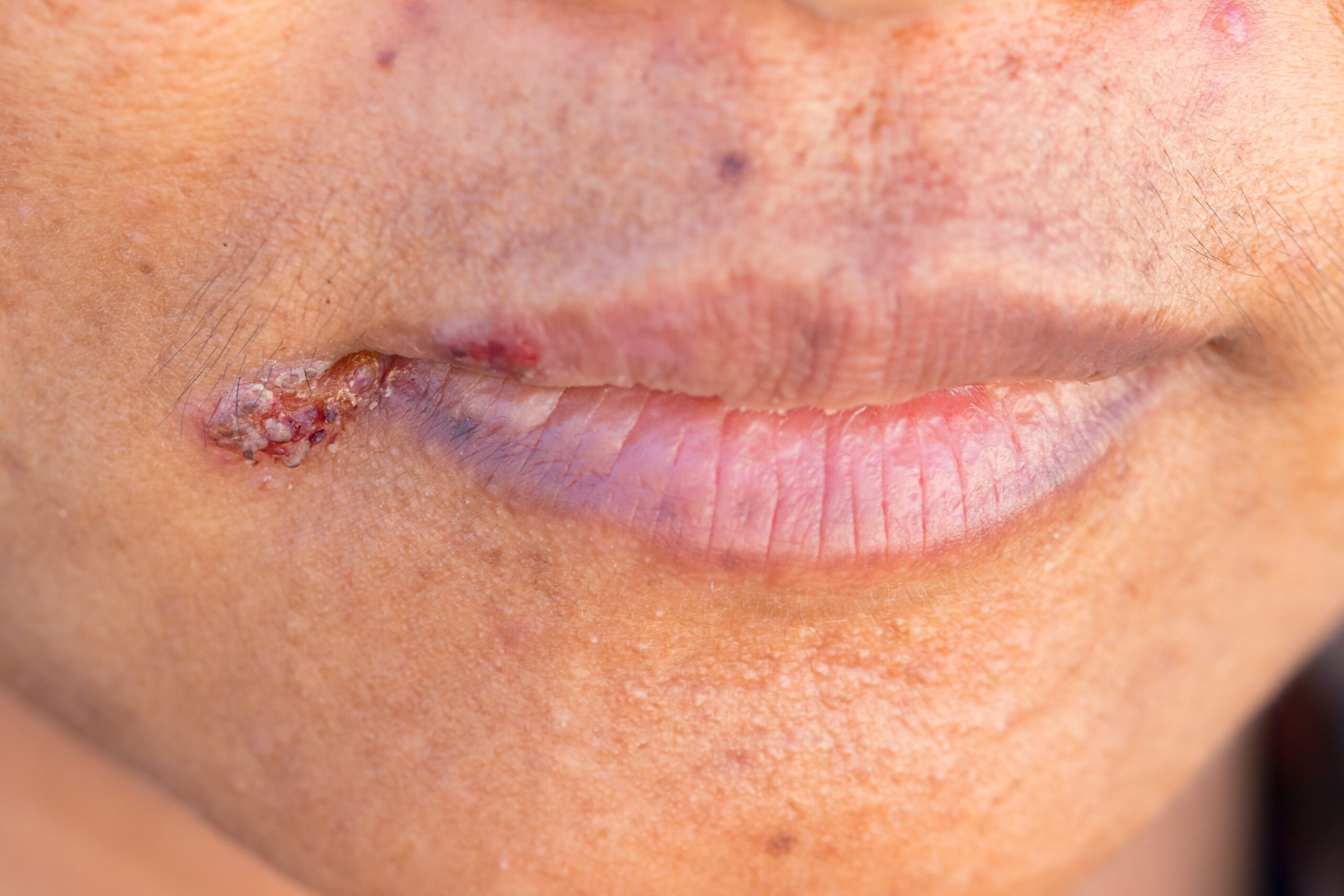 Angular Cheilitis Causes Symptoms And Treatments Bluem® Uk